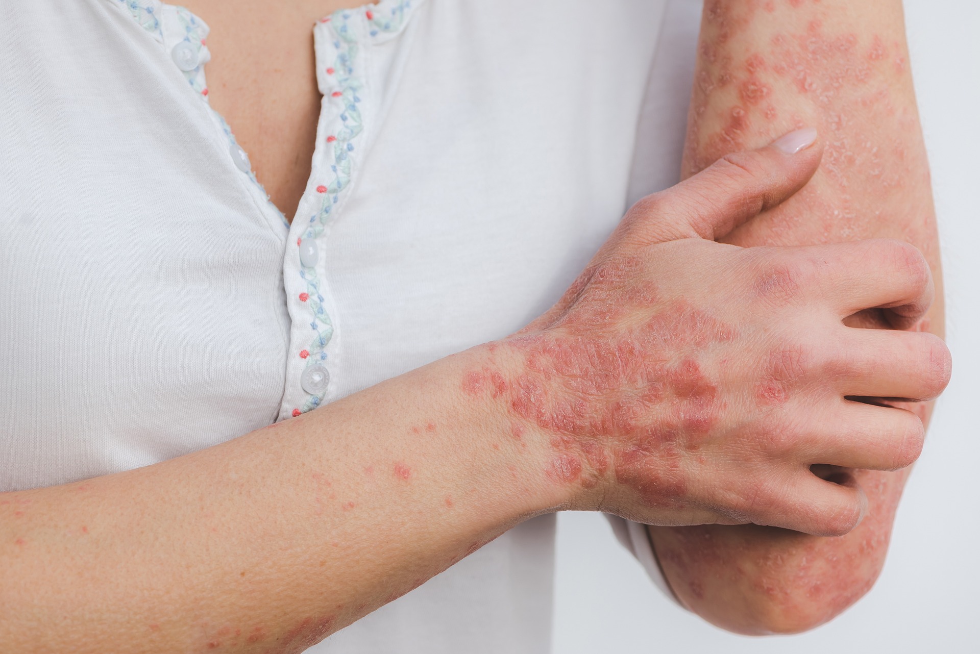 Dermatitis inflamación de la piel: causa y tratamiento